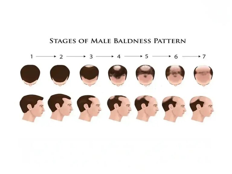 Male Pattern Baldness: What You Need to Know - QHT Regrow