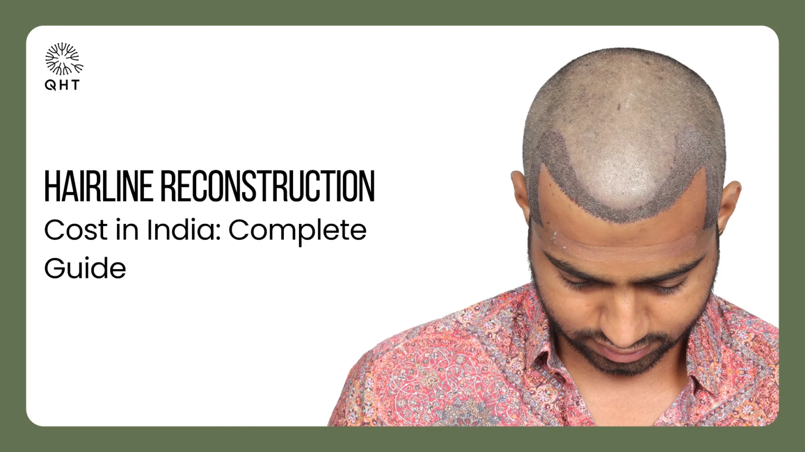 Hairline Reconstruction Cost in India | Best Clinics & Methods
